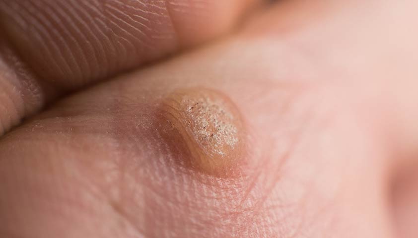 Warts in children. How to understand that it is a wart? What is the ...