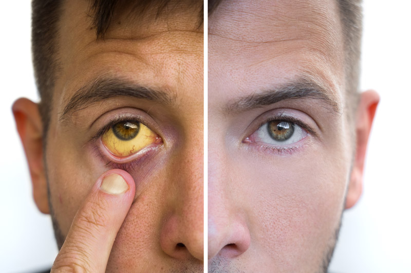 What Causes Yellow Eyes - Kidsapo